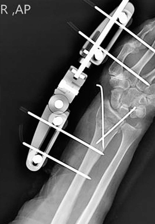 Dynamic Distal Radius External Fixator