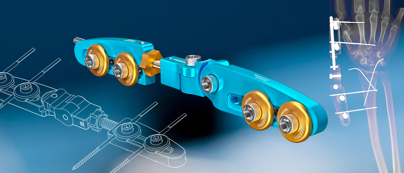 Dynamic Distal Radius External Fixator
