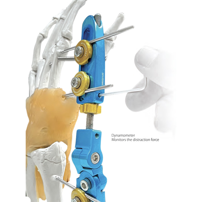 Dynamic Distal Radius External Fixator
