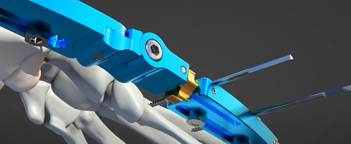 Dynamic Distal Radius External Fixator