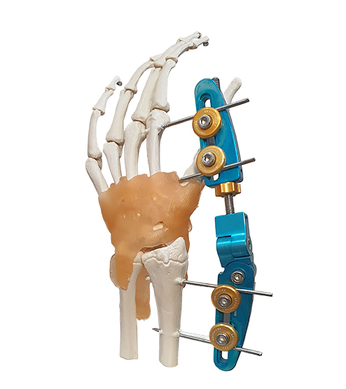 Dynamic Distal Radius External Fixator