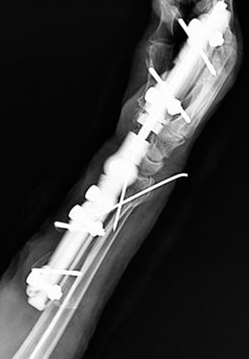 Dynamic Distal Radius External Fixator