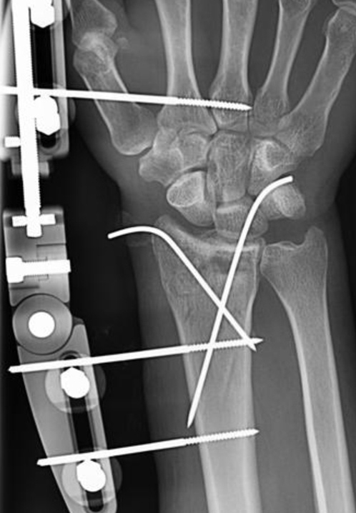 Dynamic Distal Radius External Fixator